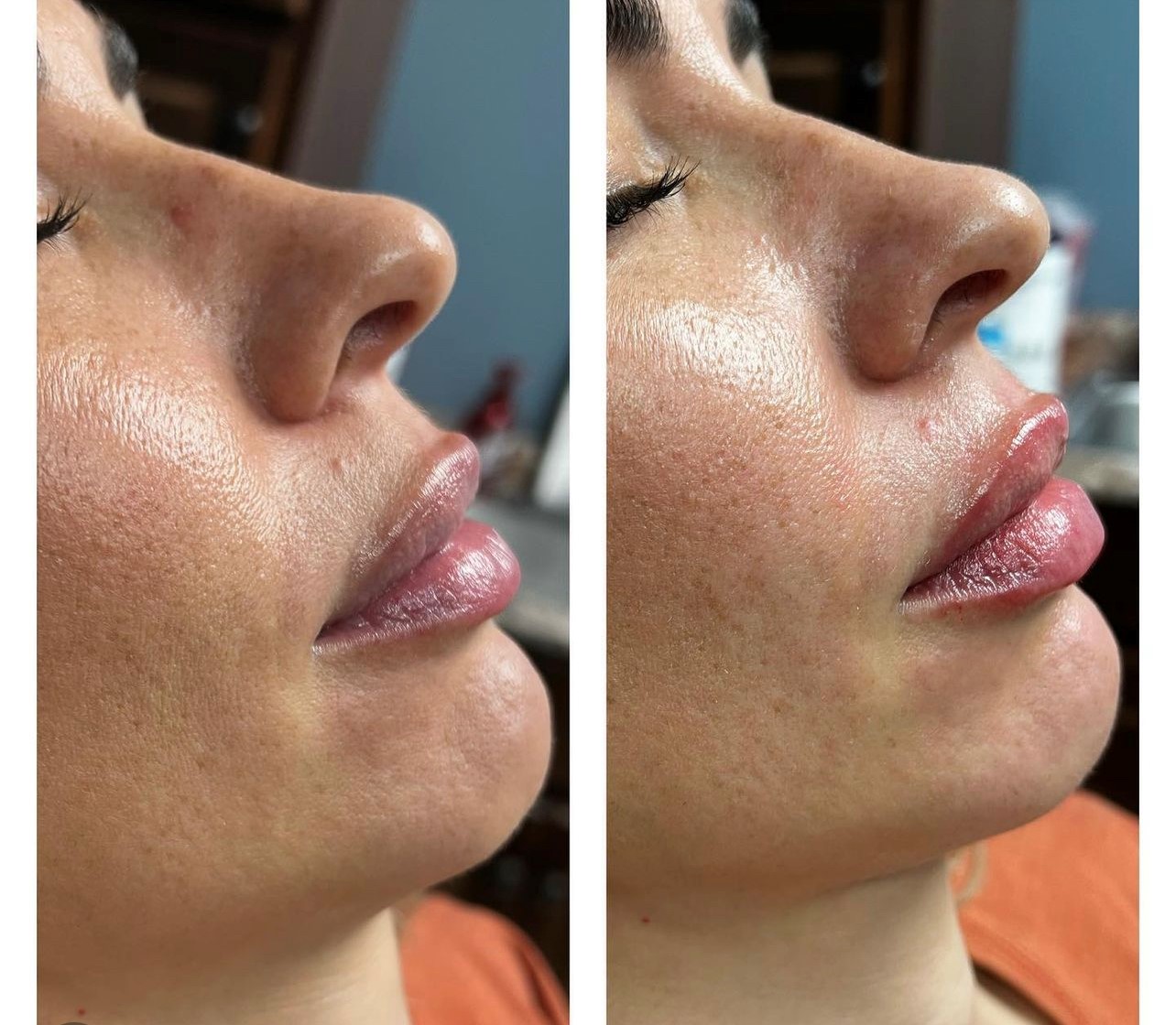 Dermal Filler - Alazzo Med Spa